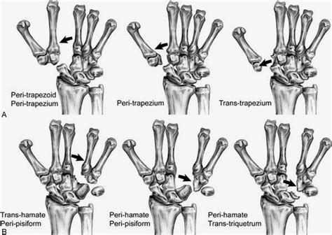 腕部骨脫位carpal Bone Dislocation 小小整理網站 Smallcollation