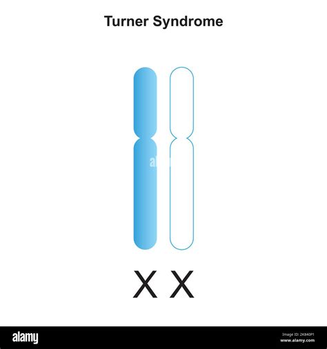 Scientific Designing Of Turner Syndrome Monosomy X Colorful Symbols