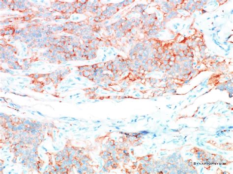 Ihc With Synaptophysin Showing Tumor Cells Arranged In Clusters Ihc