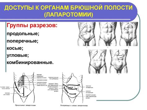 Классификация оперативного доступа к органам брюшной полости