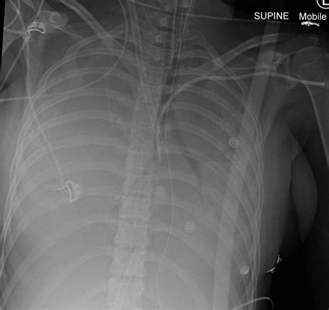 Respiratory System Complications Alfred Ecmo Guideline