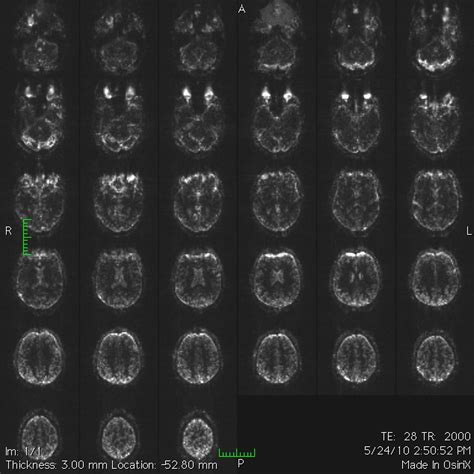 Practical Fmri The Nuts And Bolts Common Intermittent Epi Artifacts