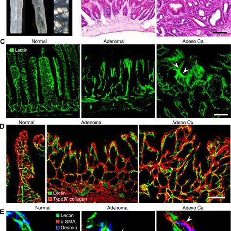 Tomato Lectin Staining Of Functional Tumor Vessels In Gastrointestinal