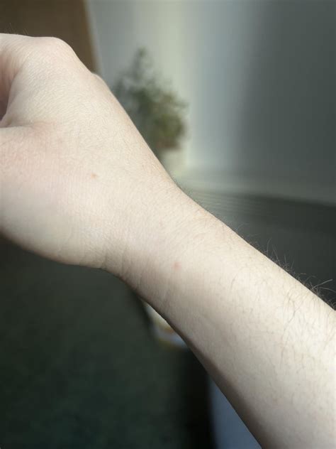 What Kind Of Bug Bites Might These Be Intense Itching No Bleeding Random Placement Cant