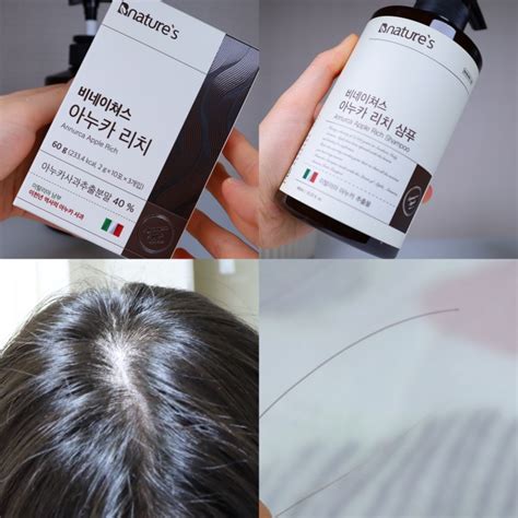 모발 영양제 아누카 사과추출분말 And 탈모 기능성 샴푸 세트로 2달간 모발 관리한 후기 네이버 블로그