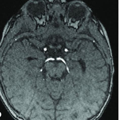 A External Photograph Showing Bilateral Eyelid Swelling With The Right