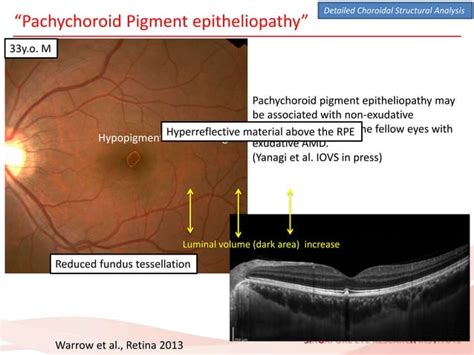 Pachychoroid Spectrum Diseases Pptx