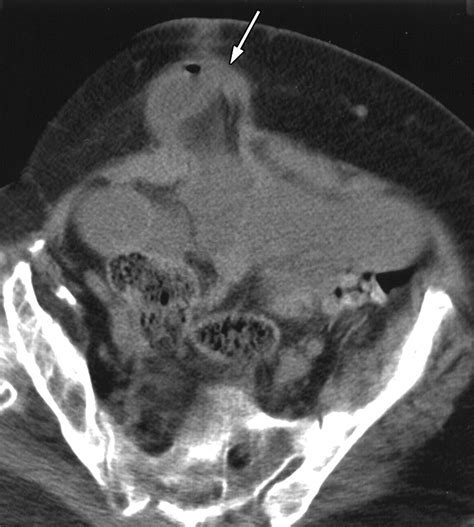 Bowel Obstruction Revealed By Multidetector Ct Ajr