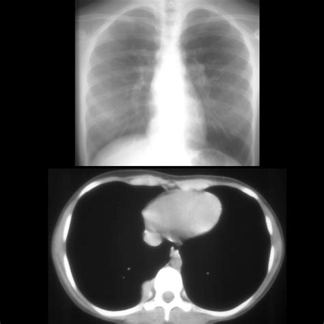 Teenager With Past History Of Wilms Tumor Pediatric Radiology Case