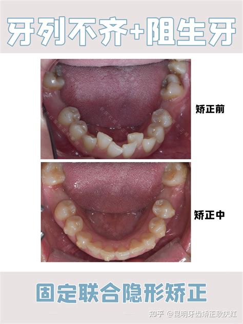 昆明牙齿矫正｜昆明正畸｜固定金属矫治器vs隐形矫正器（隐适美） 知乎