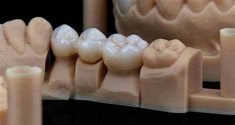 Proper Dental Crown Procedure 5 Useful Aftercare Tips