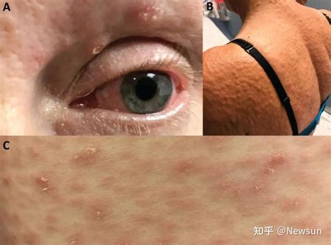 梅毒的分期及临床表现（附图片） 知乎