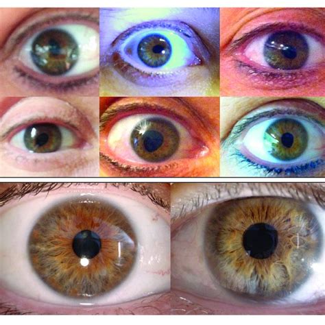 Dilatated Irregular Pupil And Iris Subatrophy In The Lover Part Two