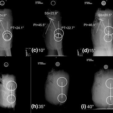 PI PT And SS On The Lateral Radiographs Of The Pelvis Obtained With Download Scientific