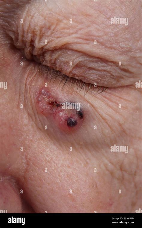 Nodular Basal Cell Carcinoma Of The Lower Eyelid In An 81 Year Old Man
