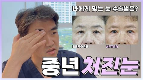 [중년눈성형] 처진 눈 나에게 맞는 수술법은 Youtube