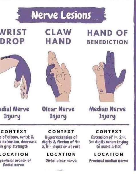 Ulnar Nerve Entrapment What Is It Symptoms Causes Treatment And More