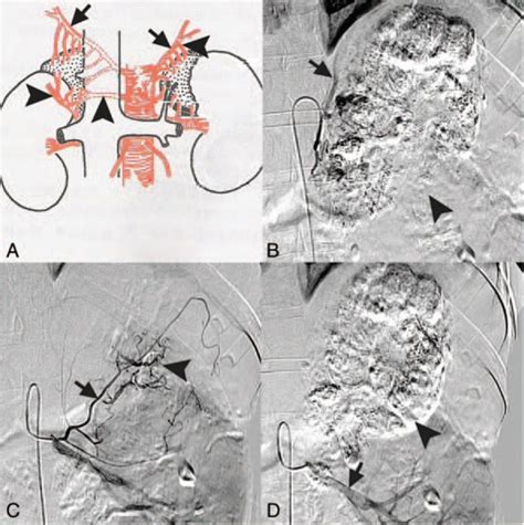 Transarterial Embolization Chemoembolization Therapy For Hepatocellular Carcinoma Fed By Adrenal