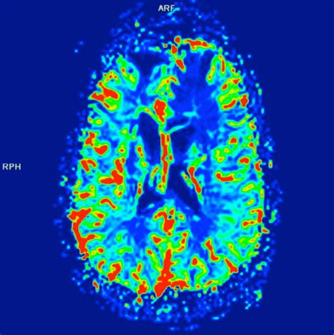 Wanted Dead Or Alive Distinguishing Radiation Necrosis From Tumor