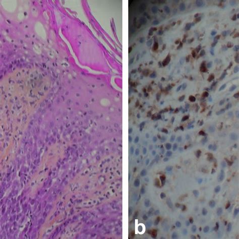 A Punch Biopsy Demonstrates A Dense Atypical Pleomorphic Lymphoid