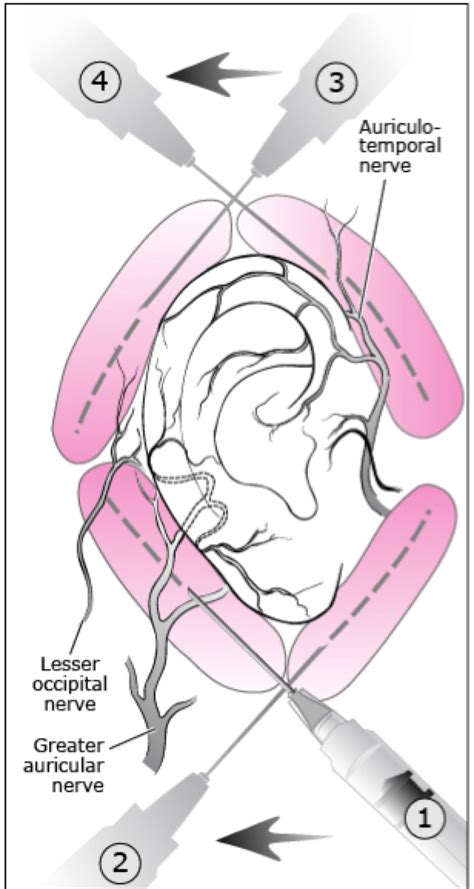 Greater Auricular Nerve Block