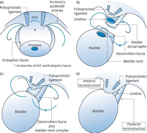 Total Pelvic Floor Reconstruction During Nonnervesparing Laparoscopic