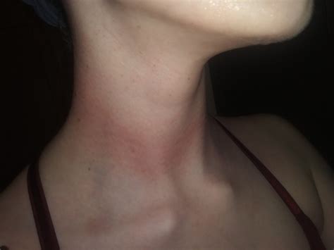 Choking Bruises
