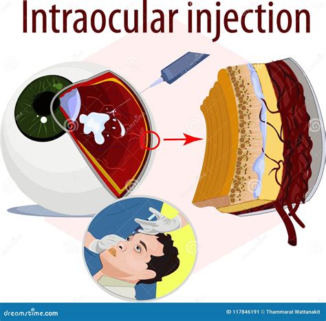 Vector Illustration Of Intraocular Injection Stock Illustration