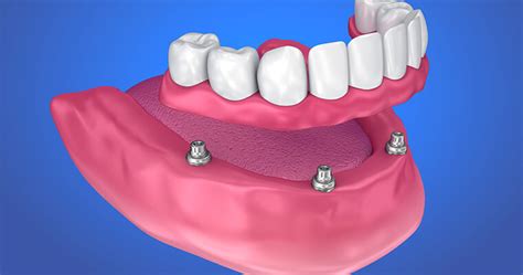 Everything You Need To Know About Denture Implants
