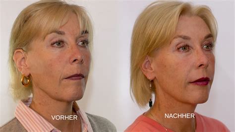 Ästhetische Dermatologie Berlin Zehlendorf Nasolabialfalten