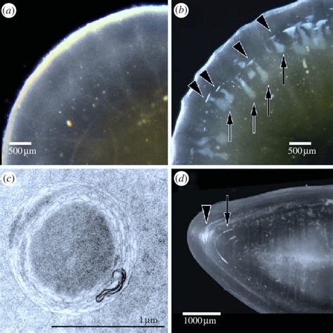 Ad Brunescent Nuclear Cataract Of Moderate To Marked Density The