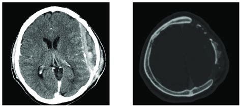 Brain Computed Tomography Scans At 8 Months After Cranioplasty Reveal Download Scientific