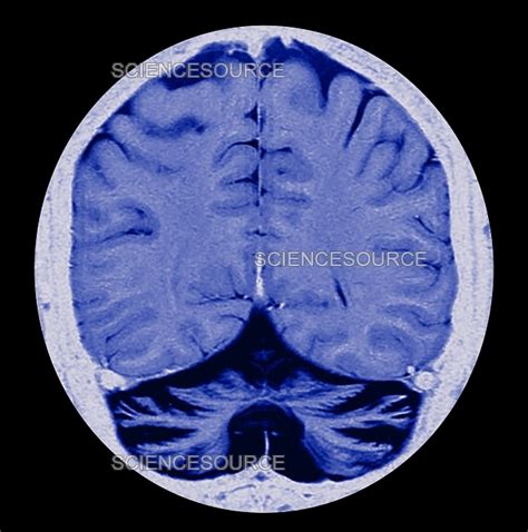 Enhanced Severe Cerebellar Atrophy Stock Image Science Source Images