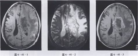恶性胶质瘤复发 磁共振成像读片中枢神经 医学