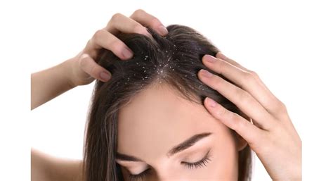 ¿cómo Eliminar La Caspa En El Cabello Onlyfarma