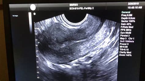 Trans Vaginal Gynaecology Ultrasound Tvs London Spectra 54 Off