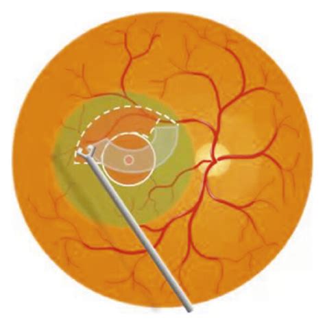 Effect Of Inverted Ilm Flap Technique On Macular Hole In Imh Patients