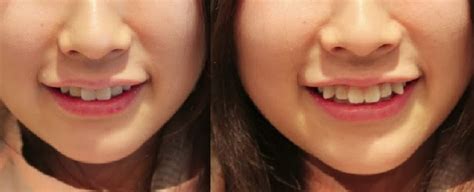 Yaeba Teeth In Japan Snaggletooth Beauty Trend Suki Desu