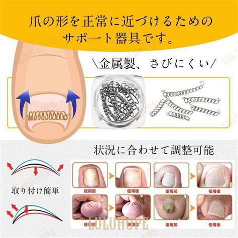 巻き爪 巻き爪チェーン 治療 爪ワイヤー テープ付き 12個 自宅で治す 矯正器具 爪切り ネイルエイド セルフケア サポーター