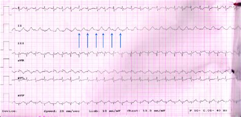 Junctional Ectopic Tachycardia Wikipedia