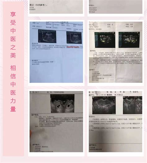 王女士子宫肌瘤治愈案例 正坤堂中医官方 正坤堂中医官方