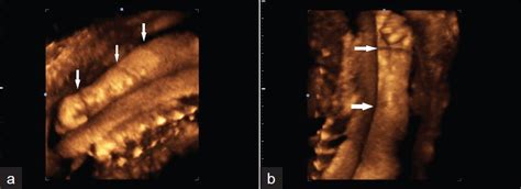 Prenatal Diagnosis Of Amniotic Band Syndrome In The Third Trimester Of Pregnancy Using 3d