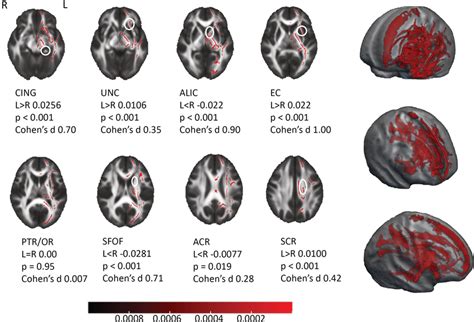 Lateralization Pattern Of White Matter Wm Tract Fractional Anisotropy Download Scientific