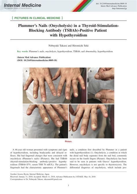 Pdf Plummers Nails Onycholysis In A Thyroid Stimulation Blocking Antibody Tsbab Positive