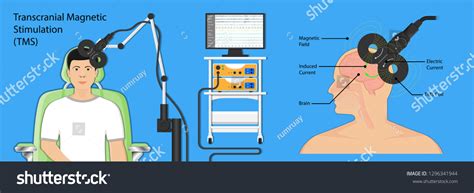 Transcranial Stimulation Image Over 40 Royalty Free Licensable Stock