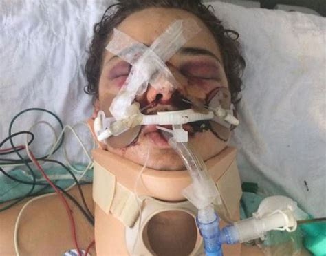 Diciottenne Colpito Alla Testa Dalla Polizia