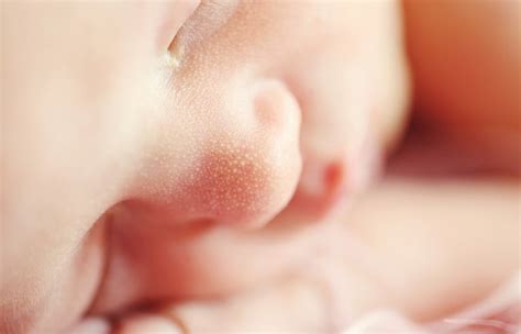 Harlequin Fetus Causes Symptoms Diagnosis