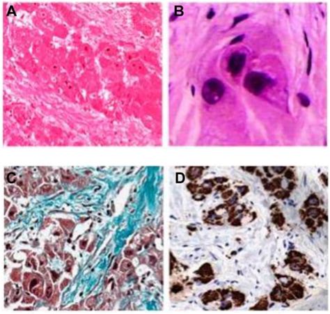 Fibrolamellar Hepatocellular Carcinoma Current Clinical Perspectives PMC