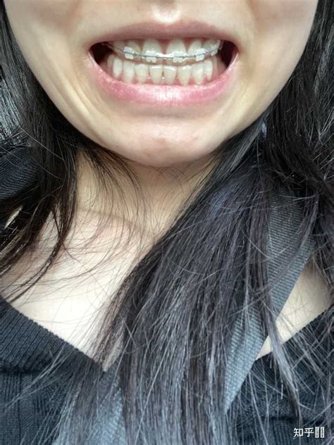 整牙会变好看还是丑？ 知乎