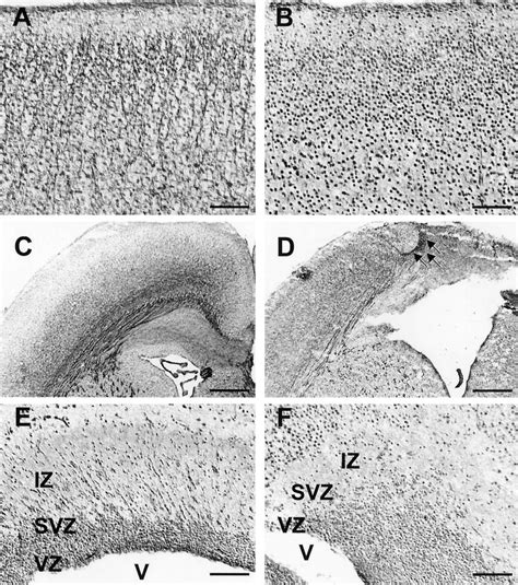 evidence of fiber reduction misdirection and cellular abnormalities in